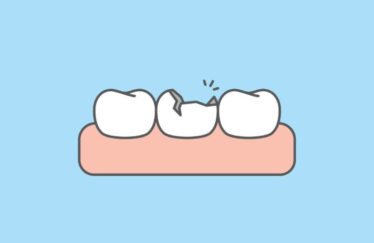 How Long Does It Take to Fix a Chipped Tooth? - Dentist Mission Viejo ...